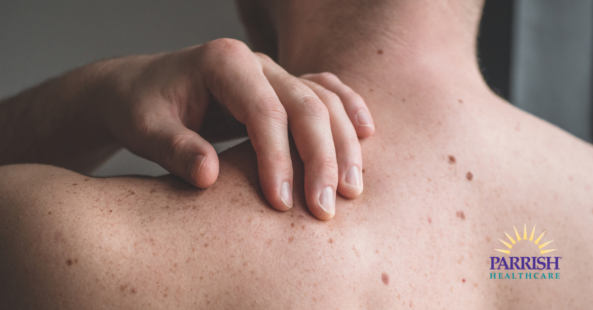 Early Signs of Skin Cancer | Parrish Healthcare